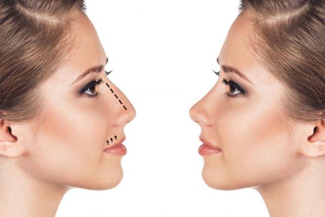 Rinofiller a Isernia Costi e Prenotazioni