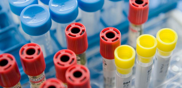 Emoglobina Glicosilata (Hb Glicata) cosa è, cosa si vede e quando farla